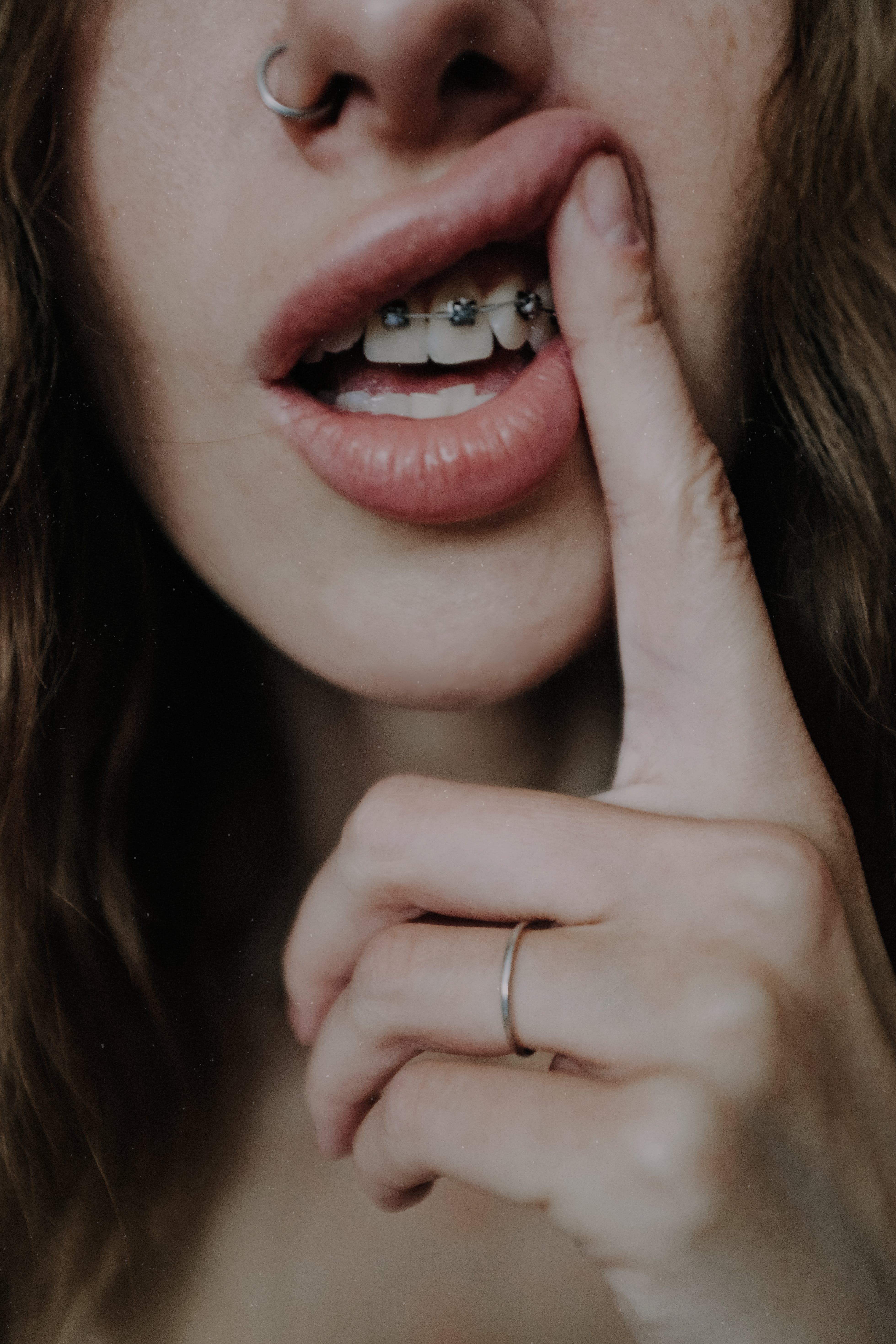 What To Do When Your Child’s Broken Braces Wire Is Poking Their Cheek ...