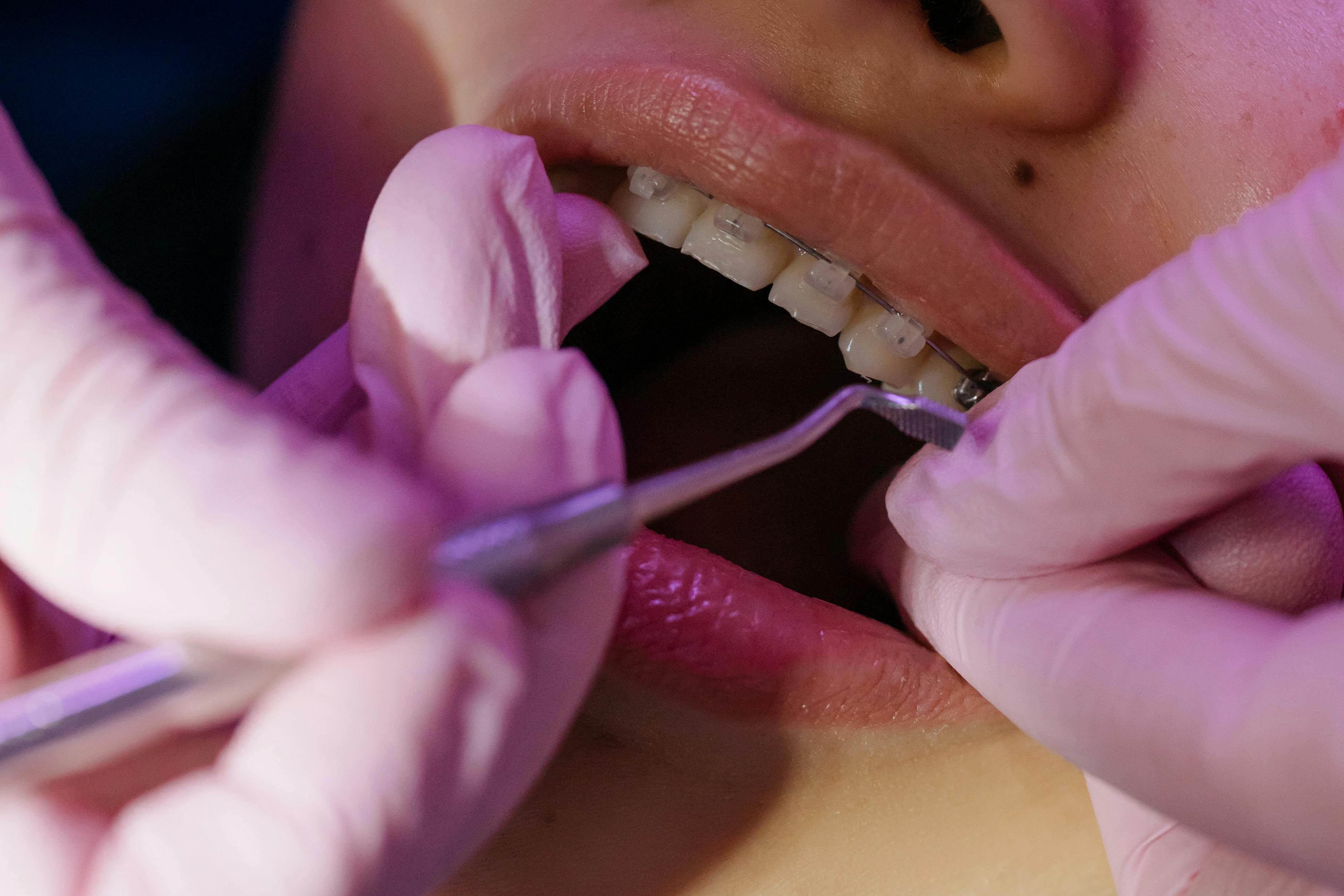 What To Do When Your Child’s Broken Braces Wire Is Poking Their Cheek ...